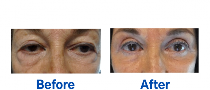 Oculoplastic Surgery Before and After Gallery - Eye Surgery Associates