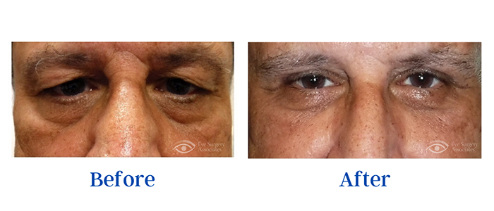 Oculoplastic Surgery Before and After Gallery - Eye Surgery Associates