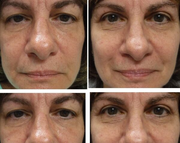 Oculoplastic Surgery Before and After Gallery - Eye Surgery Associates